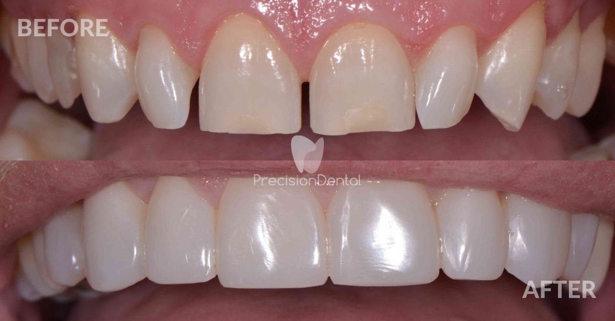 Casey Of Melbourne's Composite Veneers Makeover - Precision Dental